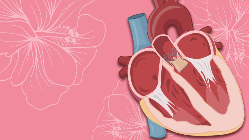 Transcatheter Aortic Valve Replacement (TAVR) – The Queen′s Health Systems